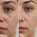 Accure Laser: Evidence-Based Acne Treatment That Works